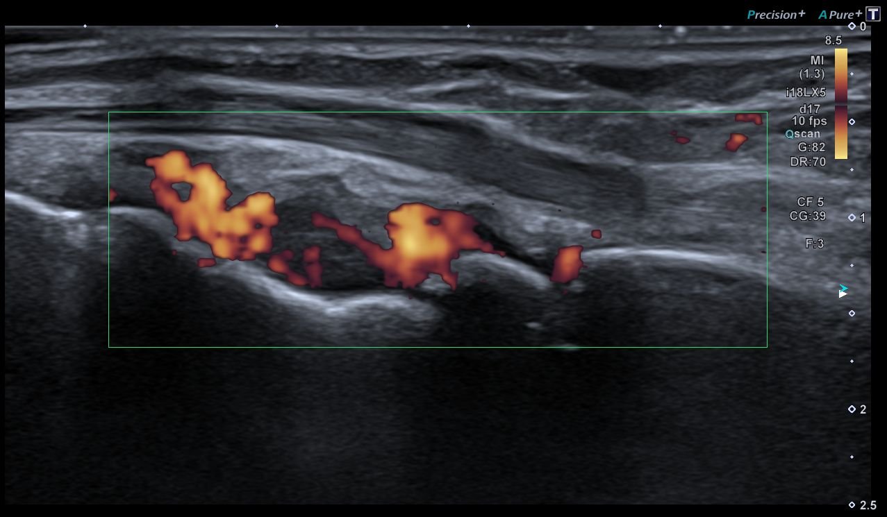Hand and Wrist Ultrasound – London Ultrasound Clinic